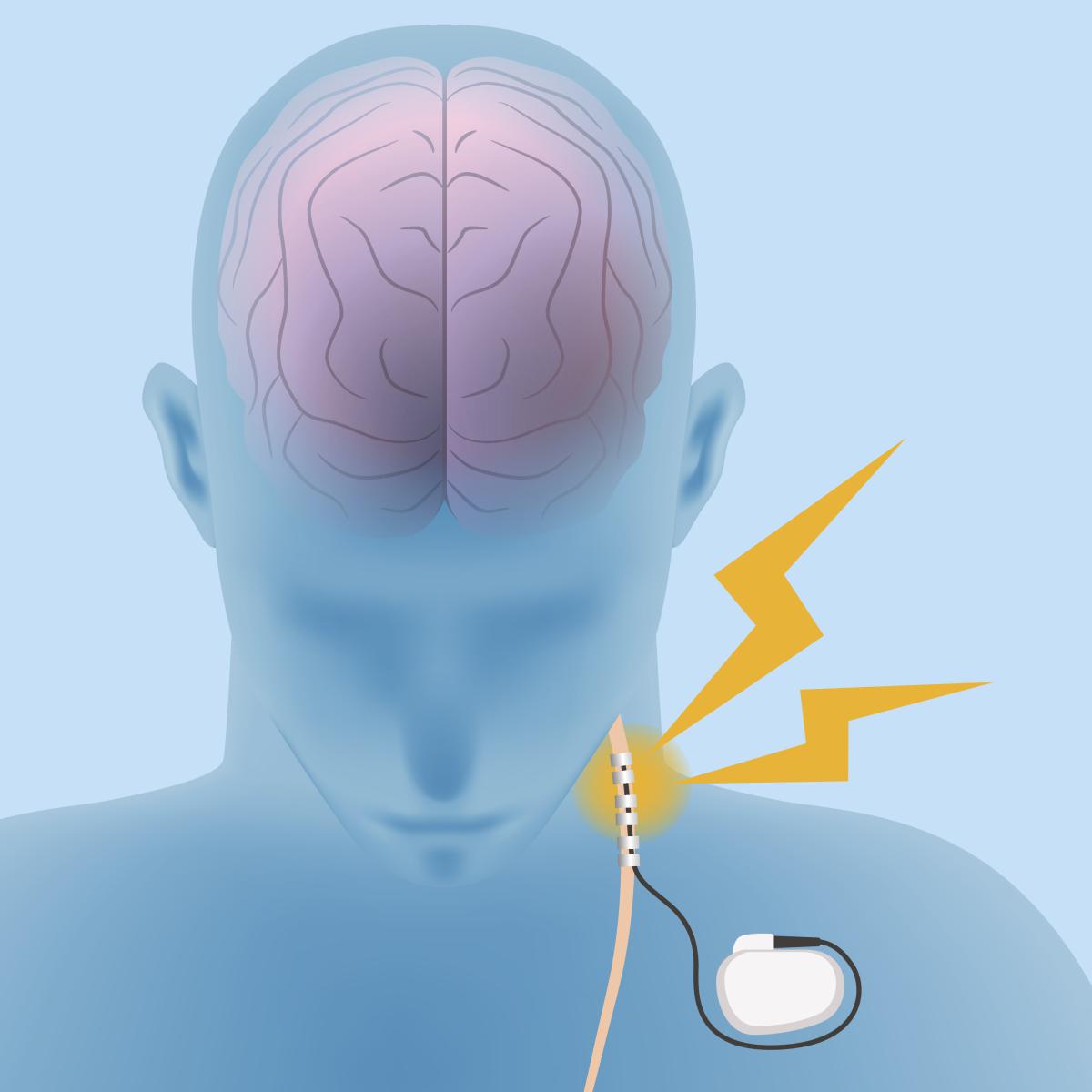 Stimulating Peripheral Activity to Relieve Conditions (SPARC) Phase 2 ... Stimulating Peripheral Activity to Relieve Conditions (SPARC) Phase 2 ...